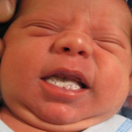 Soor beim Baby: Windel- und Mundsoor - Familie.de